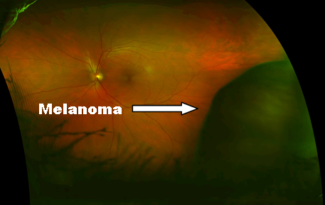 Retinal Photography (Optomap®)
